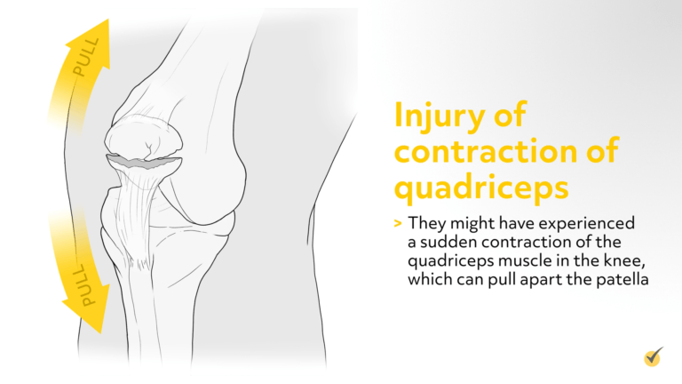 Managing Different Types of Patellar Fractures (Video)