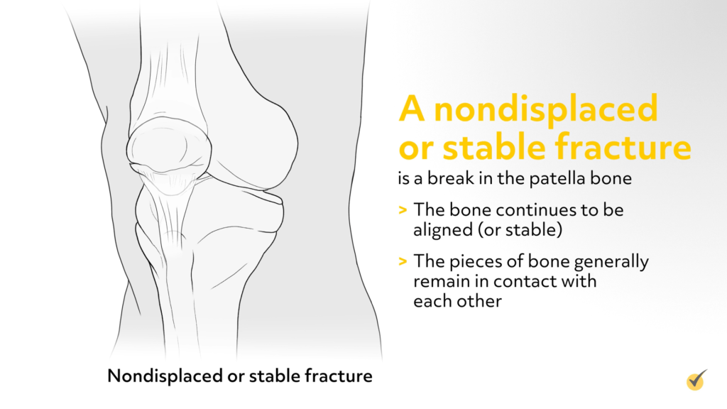 Managing Different Types of Patellar Fractures (Video)