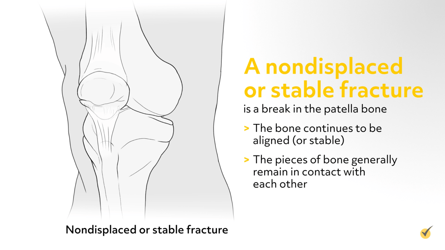 Managing Different Types of Patellar Fractures (Video)