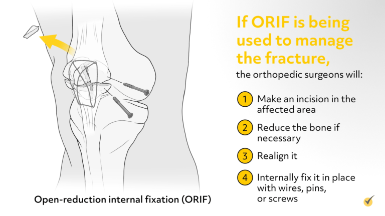 Managing Different Types of Patellar Fractures (Video)