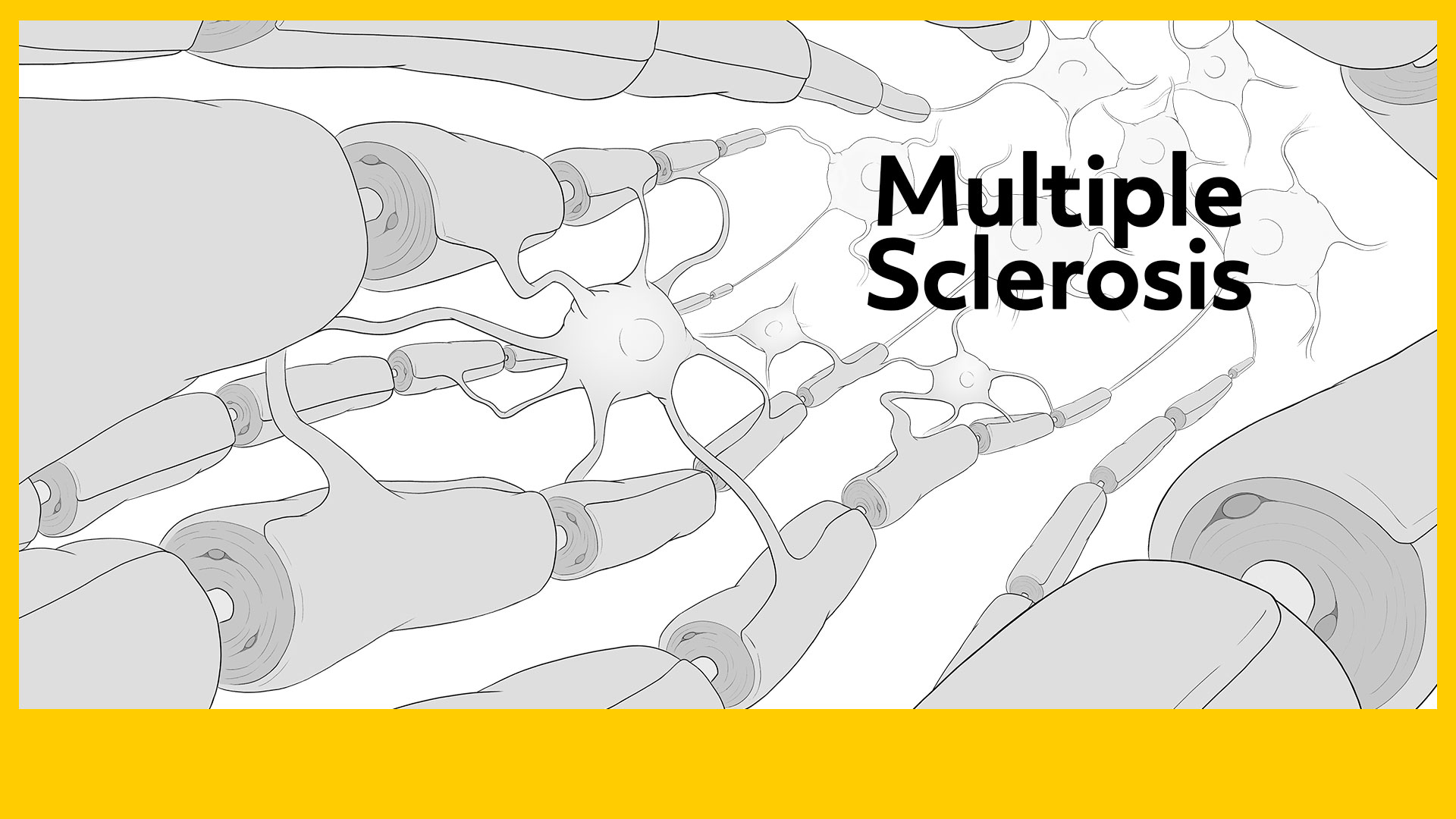 Multiple Sclerosis (Video)
